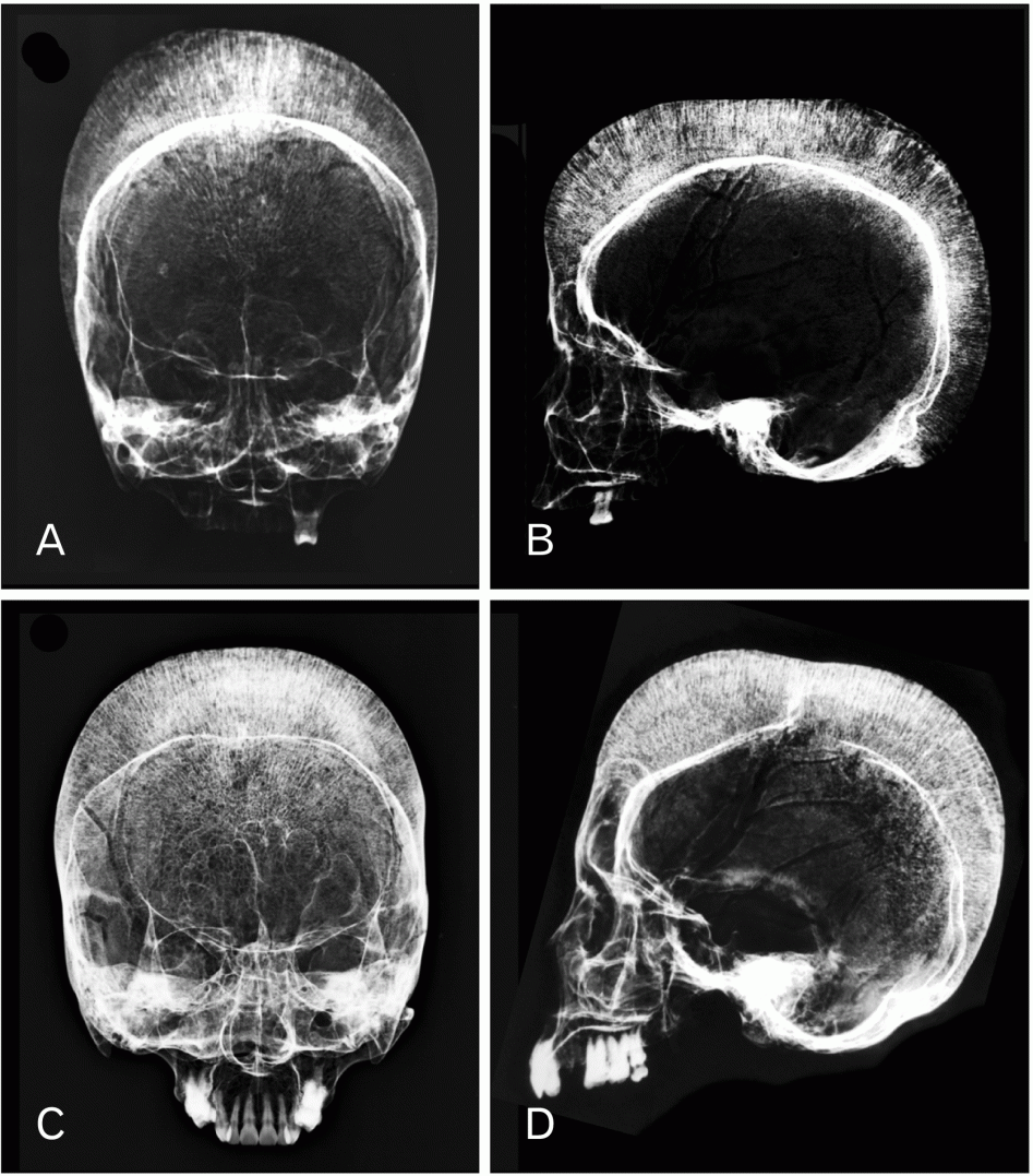 Gross and radiographic appearance of porotic hyperostosis and cribra ...