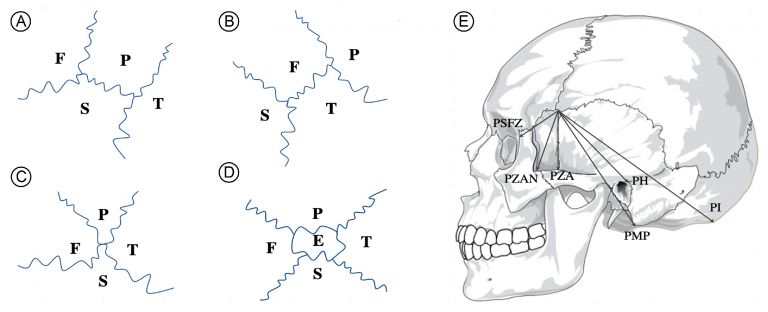 Classification and morphometric features of pterion in Thai population ...