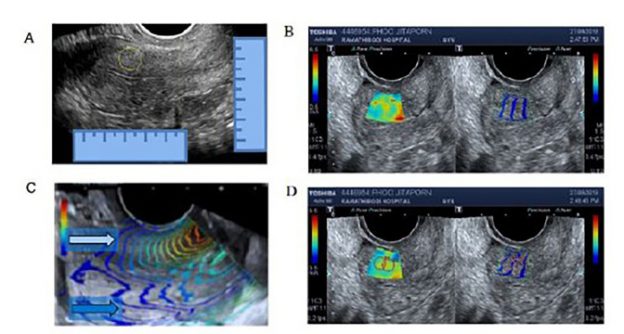 A Comparison Of Shear Wave Elastography Between Normal Myometrium Uterine Fibroids And
