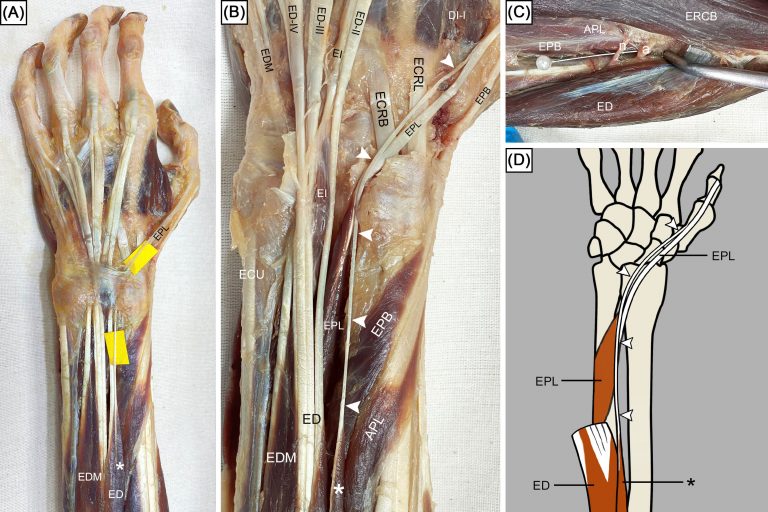 Accessory extensor pollicis longus from the extensor digitorum: a rare ...