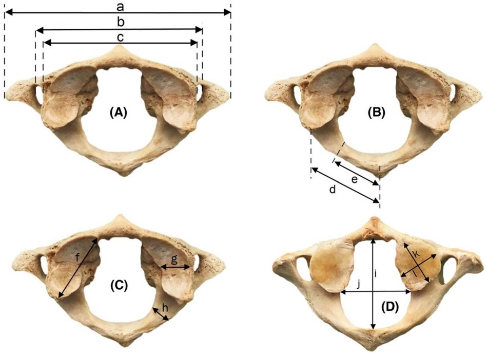 Morphometric analysis of dry atlas vertebrae in a northeastern Thai ...