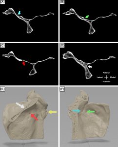 Topographical study of scapular foramina and scapular nutrient foramina ...