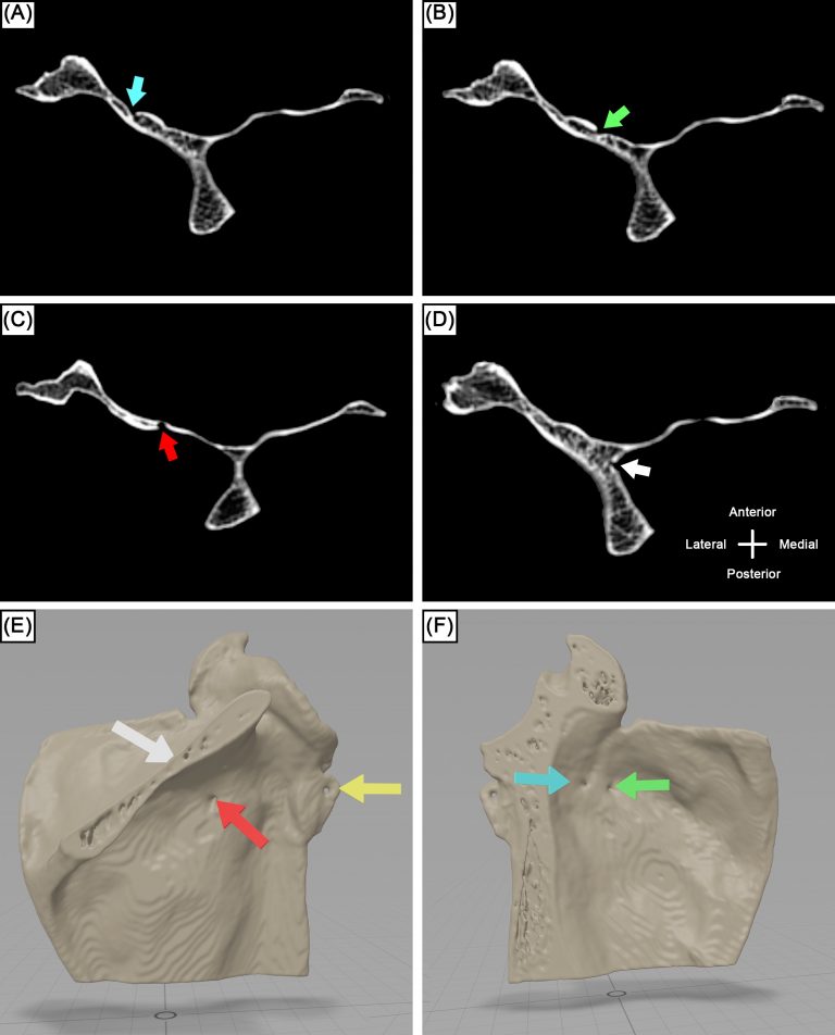 Topographical study of scapular foramina and scapular nutrient foramina ...