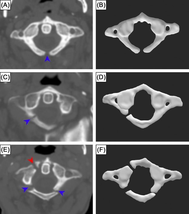 Radiological Study of Atlas Arch Defects with Meta-Analysis and a ...
