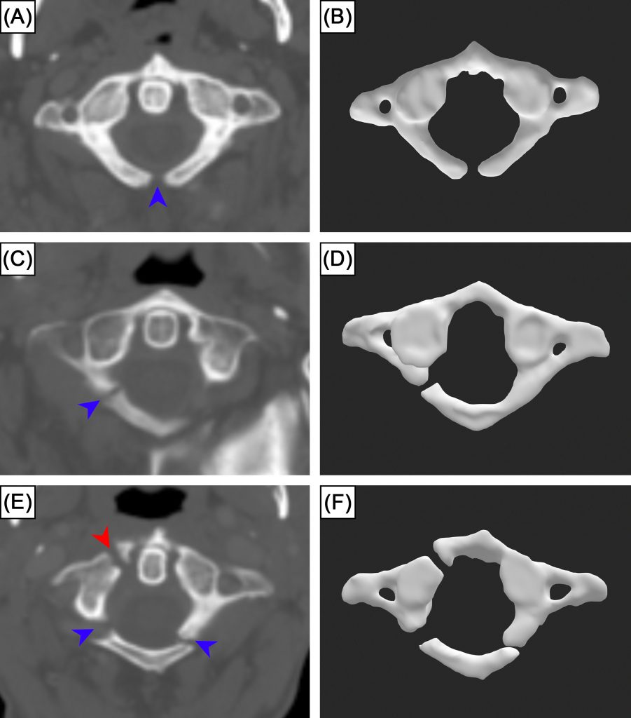 Radiological Study of Atlas Arch Defects with Meta-Analysis and a ...