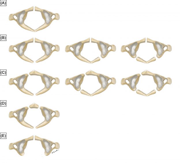 Radiological Study of Atlas Arch Defects with Meta-Analysis and a ...