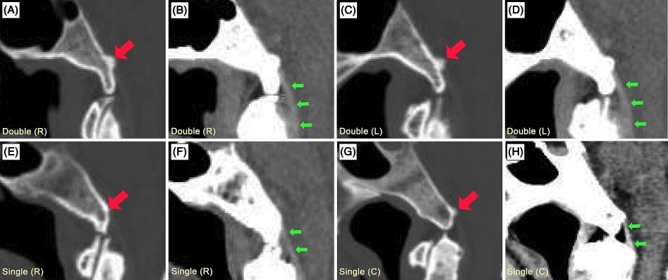 Basilar tubercles and eminences of the clivus: Novel anatomical ...