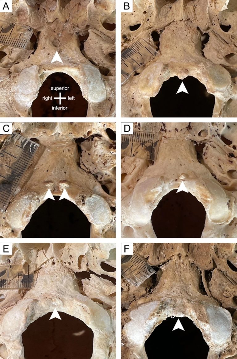 Anatomical and morphometric study of variations of the clivus in dried ...