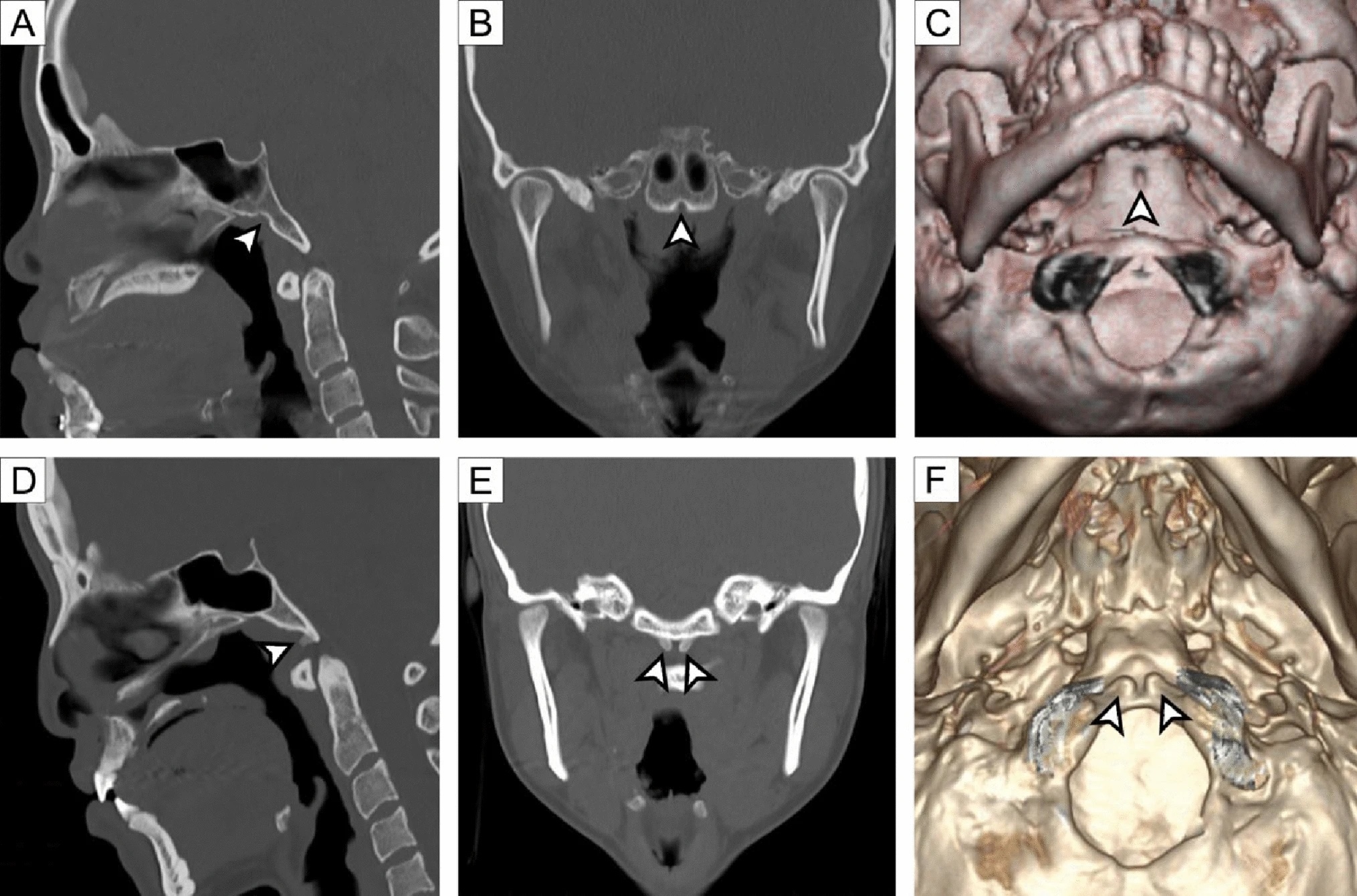 Radiological Assessment of Clival Morphological Variants in the Thai ...