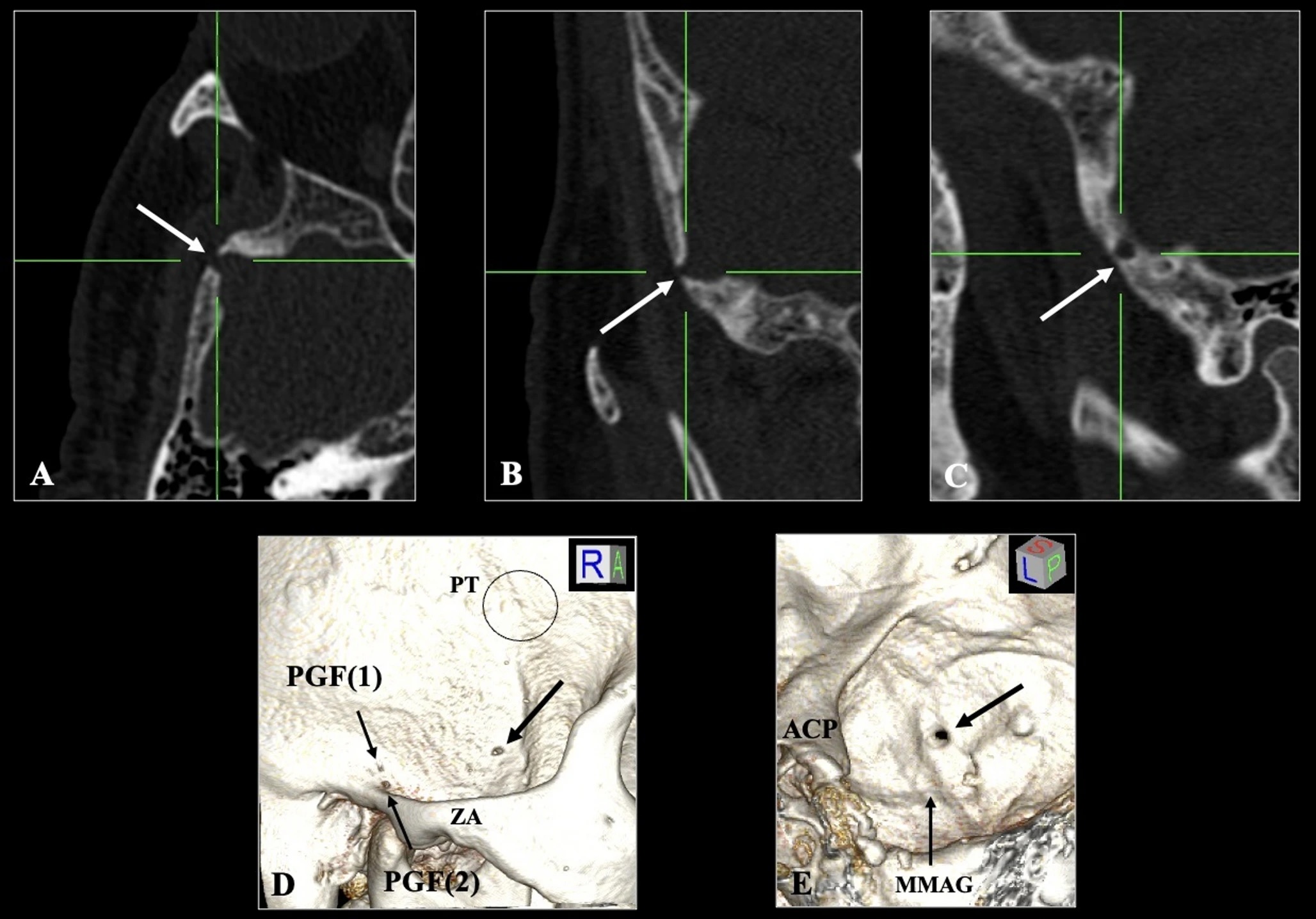 An unusual emissary foramen of the temporal bone – #Anatomy SC Mahidol ...