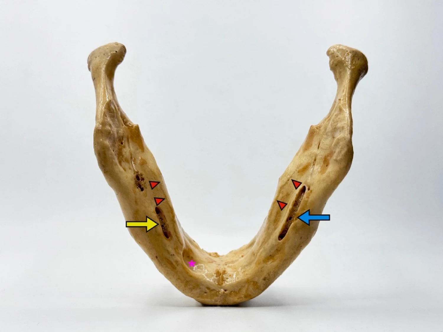 Bilateral incomplete mandibular canals: an embryological analysis of ...
