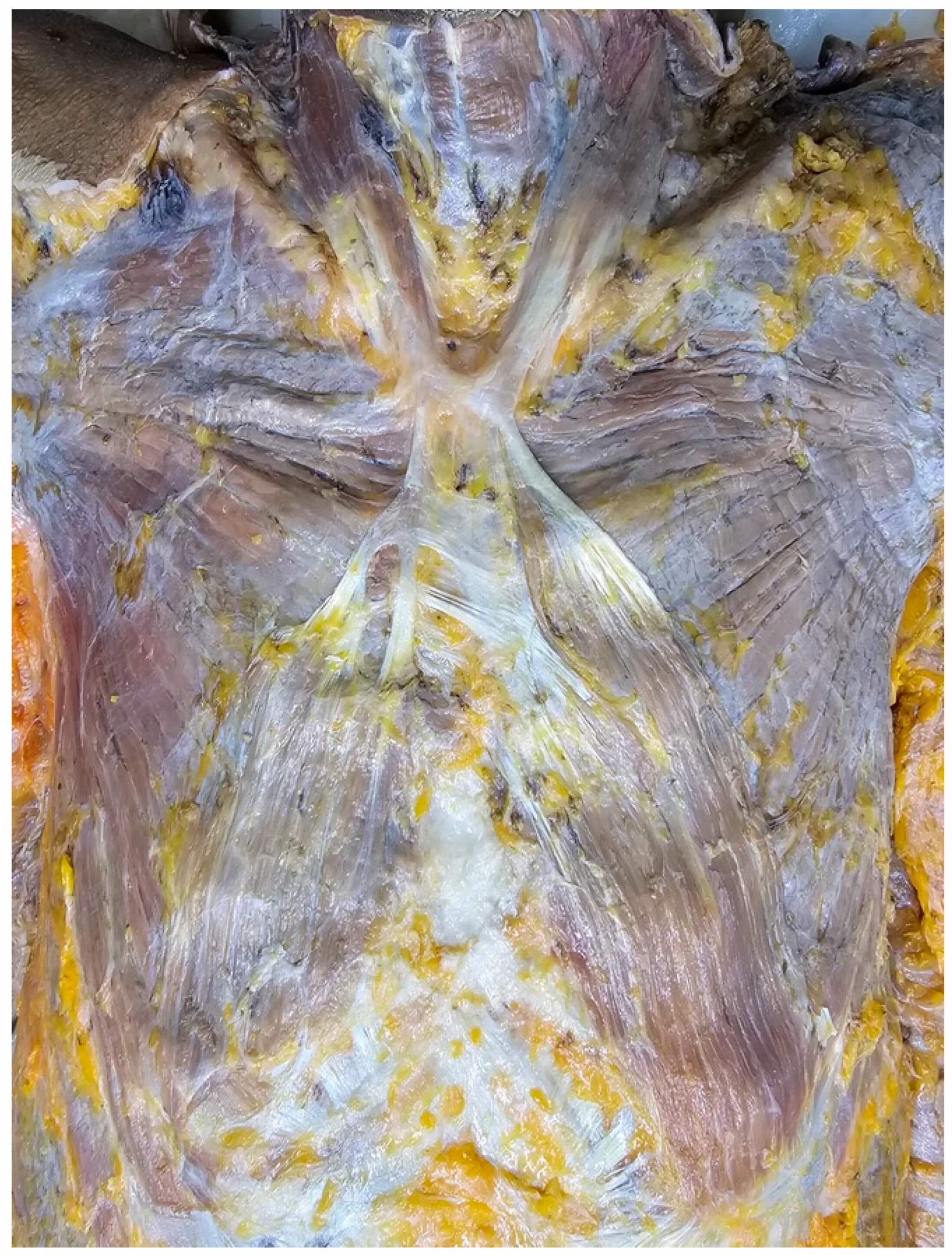 Seven-Headed Sternalis: A Case Report with Three-Dimensional ...